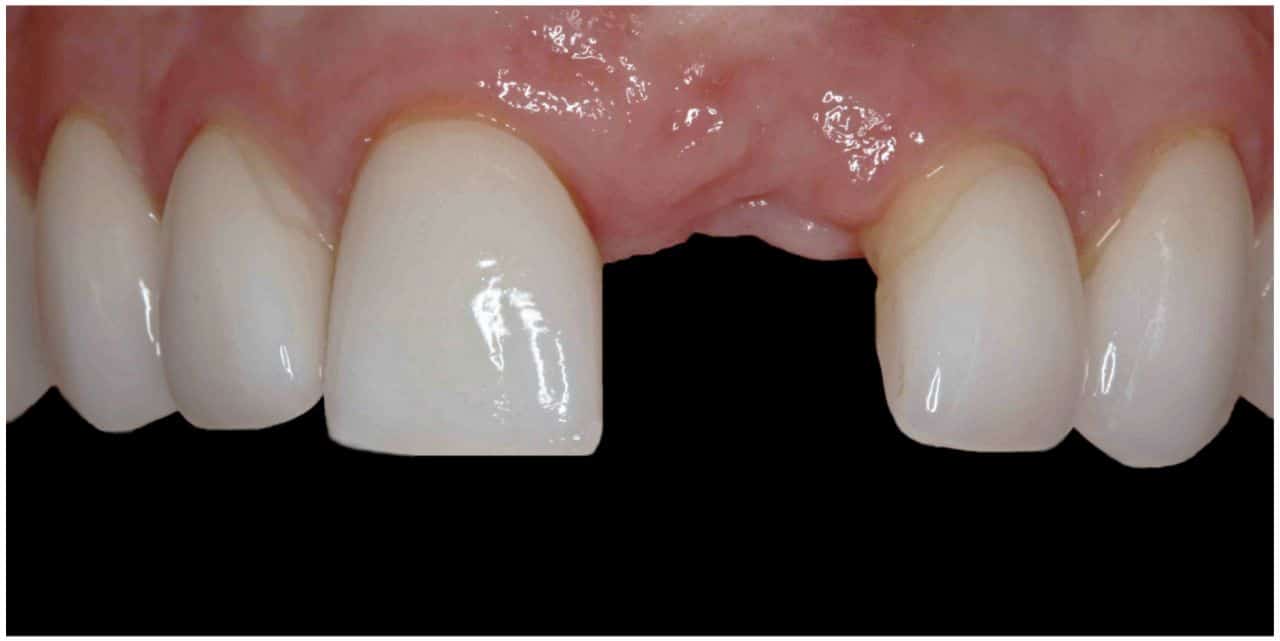 Dental Implants Wilmington, NC | Before & After Photos