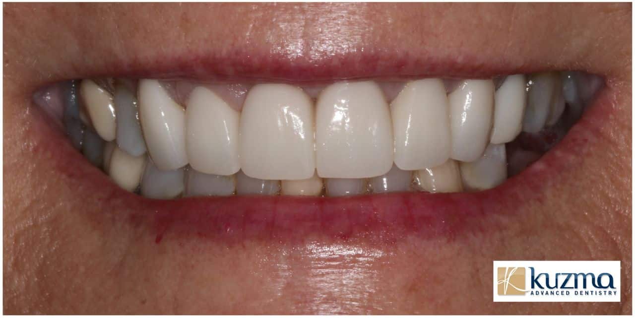 Dental Implants Wilmington, NC | Before & After Photos